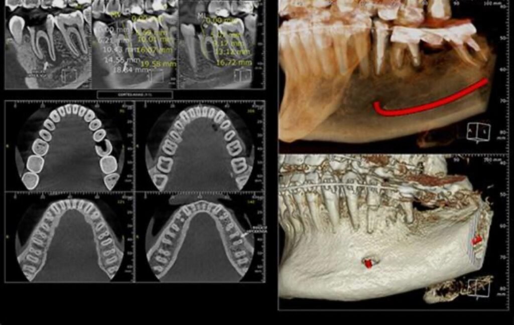 Implante dentário em 5 minutos? Ténica promete cirurgia rápida com ...